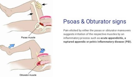 آپاندیسیت : علل ، علایم و درمان » دکتر علیرضا مهربان - فوق تخصص گوارش و ...