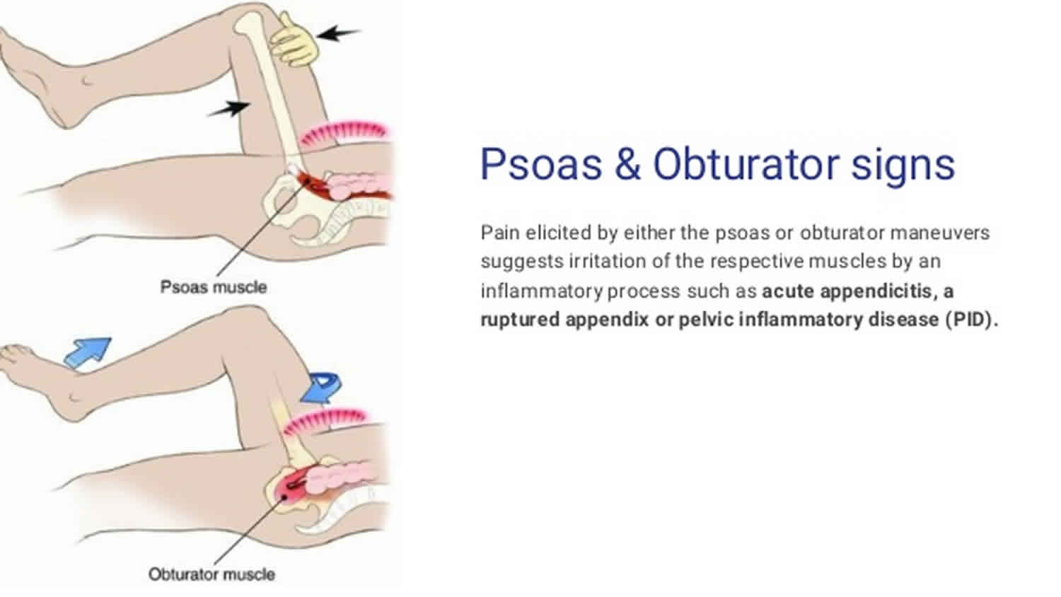 آپاندیسیت : علل ، علایم و درمان » دکتر علیرضا مهربان - فوق تخصص گوارش و ...